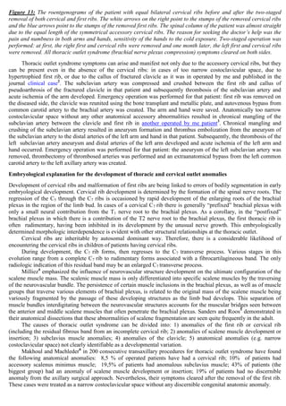 Thoracic Outlet Syndrome: Anatomy, Symptoms, Diagnostic Evaluation and ...
