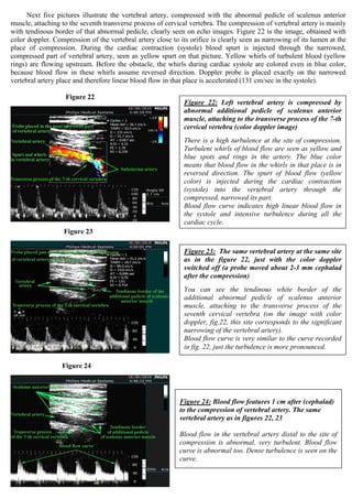 Thoracic Outlet Syndrome: Anatomy, Symptoms, Diagnostic Evaluation and ...