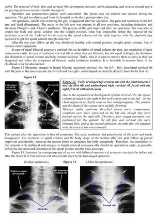 Thoracic Outlet Syndrome: Anatomy, Symptoms, Diagnostic Evaluation and ...