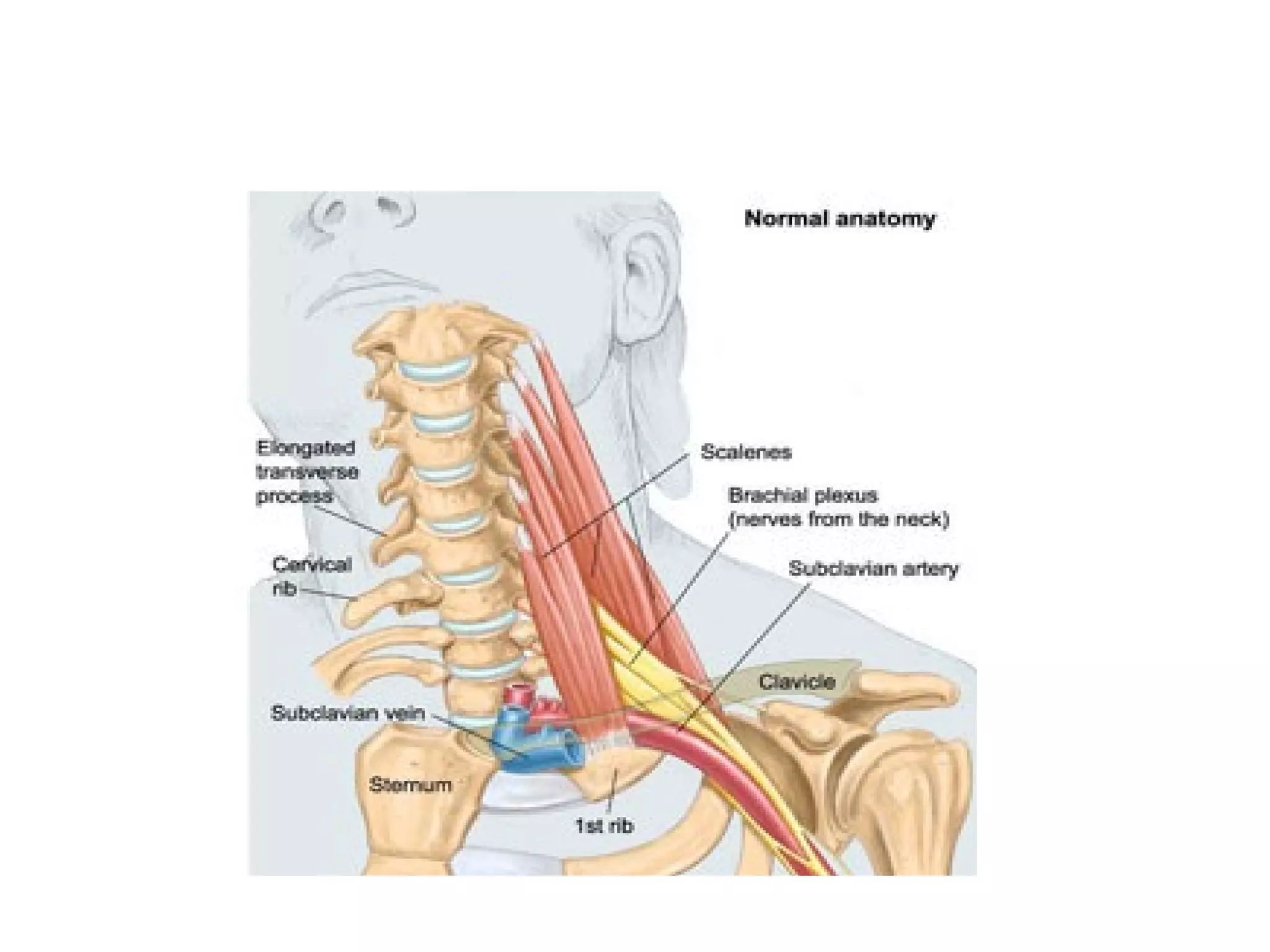 Thoracic outlet syndrome | PPT