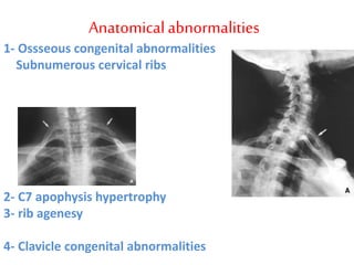 Thoracic Outlet Syndrome X Ray