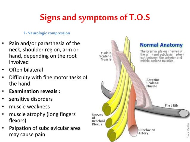 Thoracic outlet syndrome