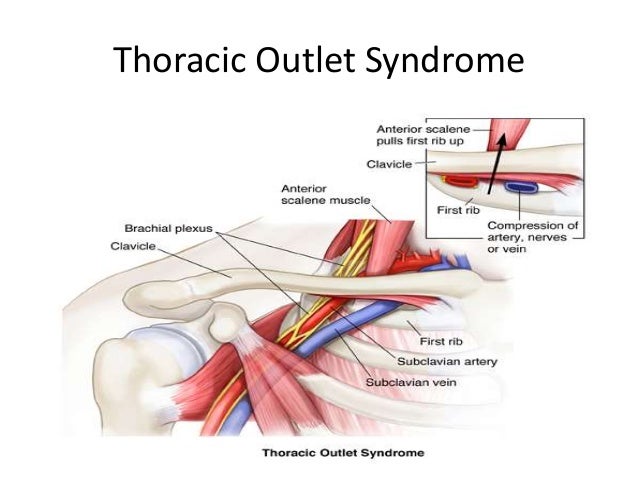 Thoracic outlet syndrome