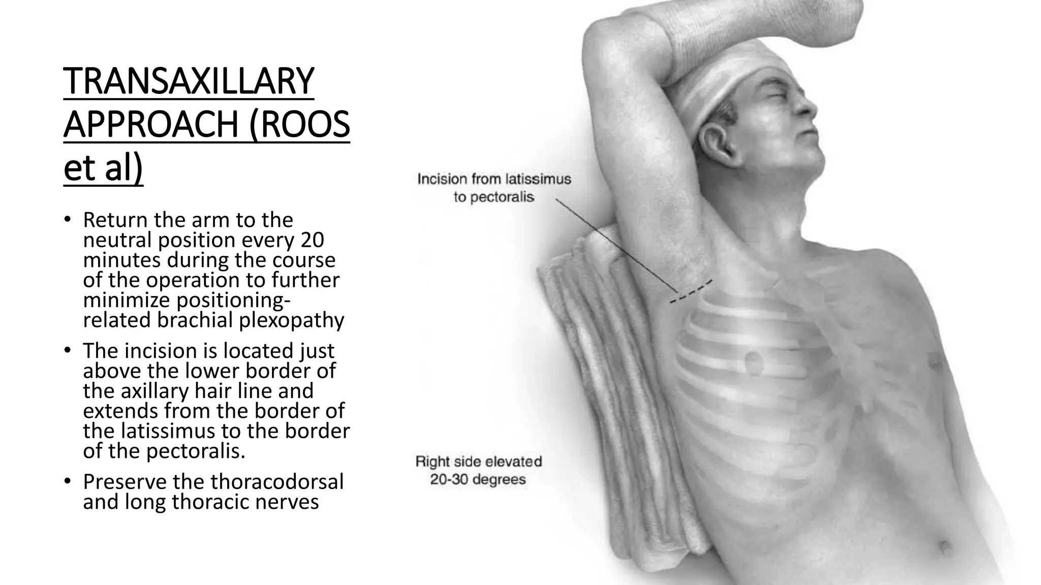 Thoracic outlet syndrome | PPTX