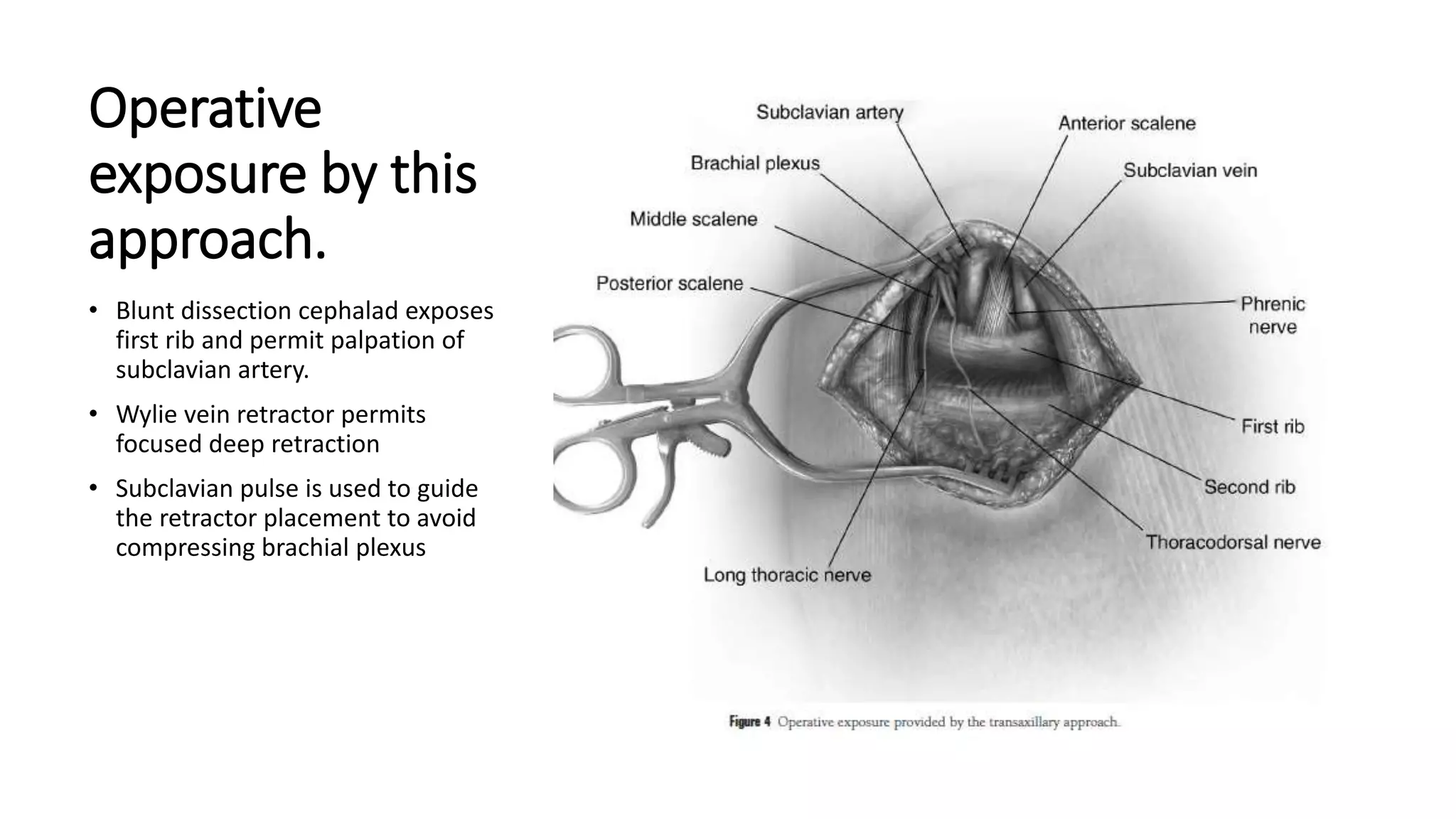 Thoracic outlet syndrome | PPTX