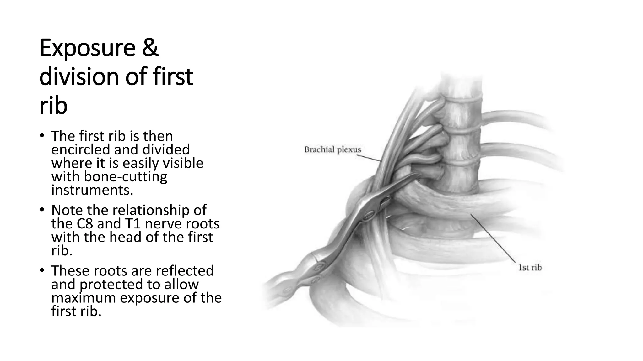 Thoracic outlet syndrome | PPTX