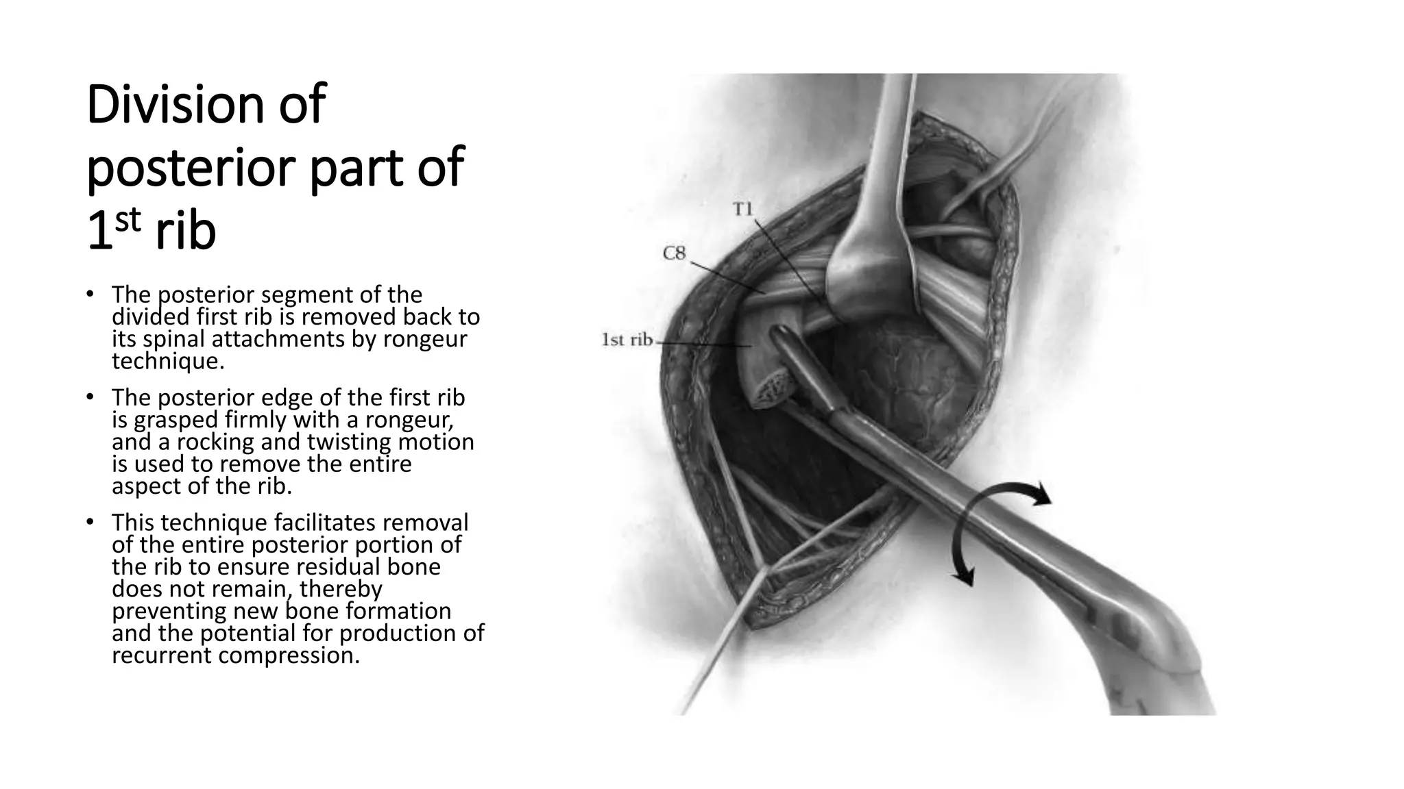 Thoracic outlet syndrome | PPTX