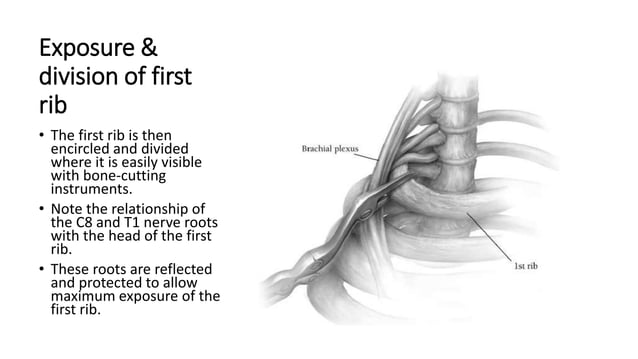 Thoracic outlet syndrome | PPT