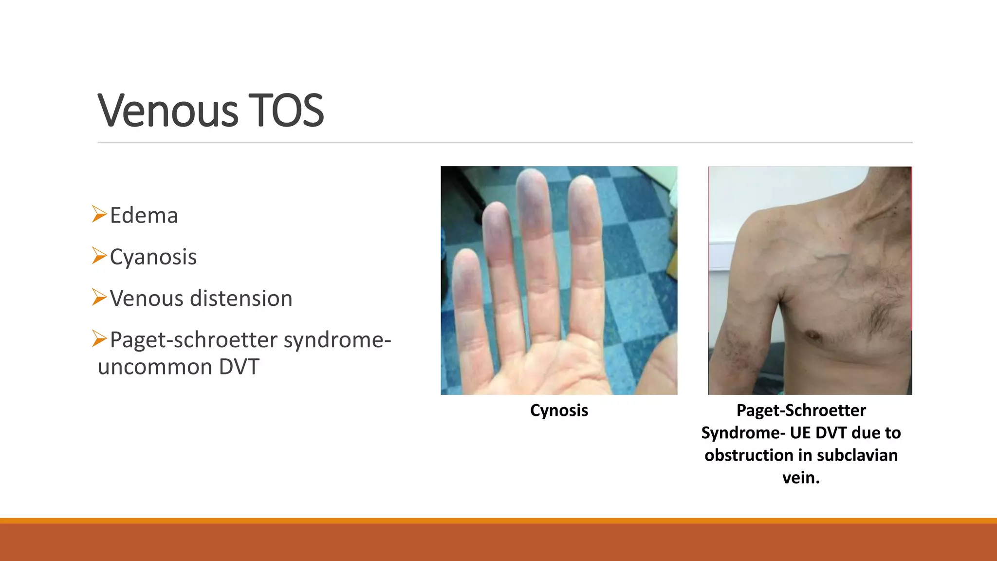 Thoracic Outlet Syndrome and Physiotherapy Management | PPTX