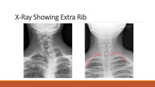 Thoracic Outlet Syndrome and Physiotherapy Management | PPTX