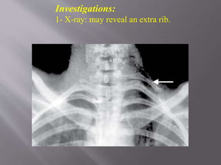Thoracic outlet syndrome | PPT