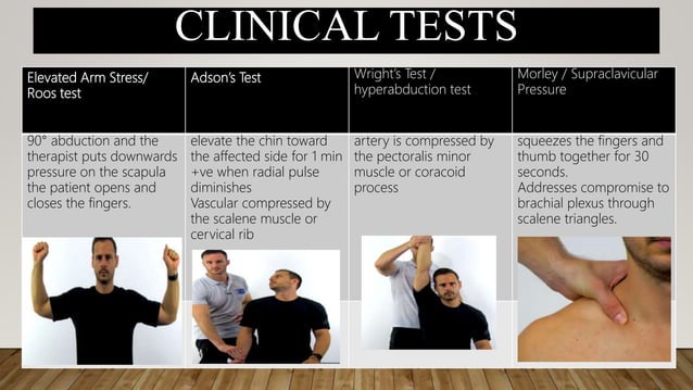Thoracic outlet syndrome/ TOS