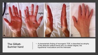 Thoracic outlet syndrome. | PPTX