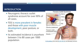 Thoracic Outlet Syndrome.pptx | Death, Injury, or Military Conflict ...