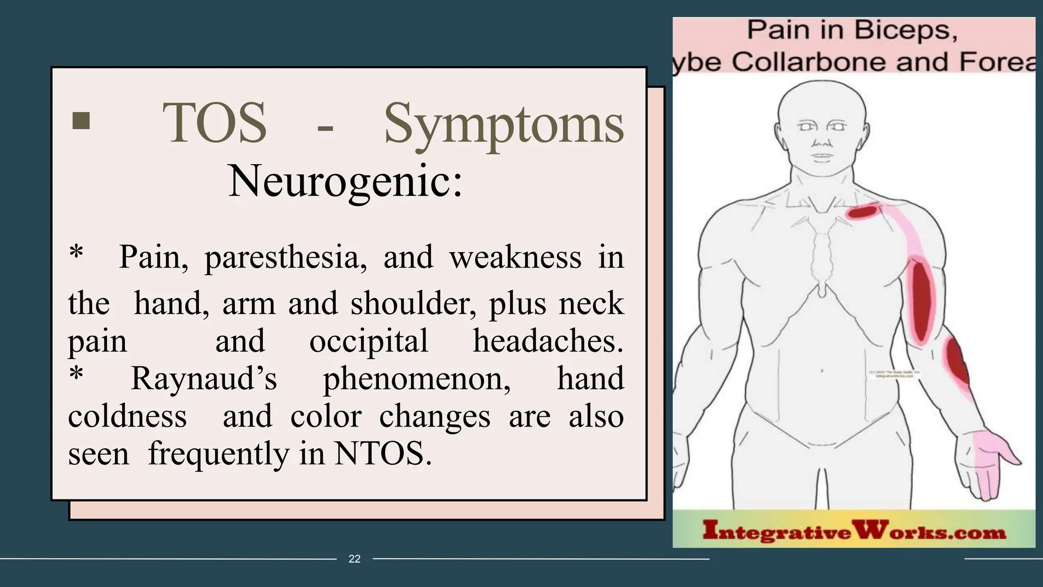 THORACIC OUTLET SYNDROME- lecture for medical students.pptx | Death ...