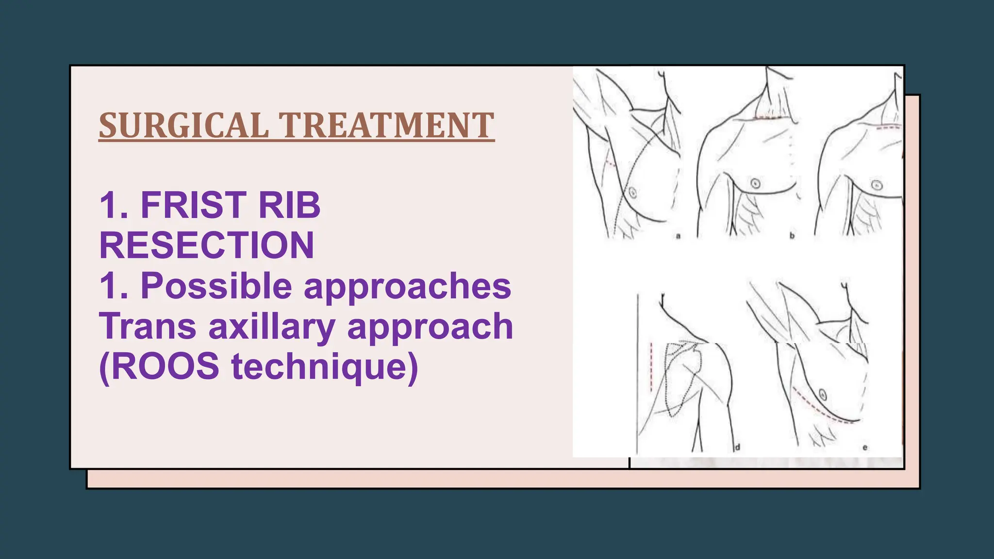 THORACIC OUTLET SYNDROME- lecture for medical students.pptx | Death ...