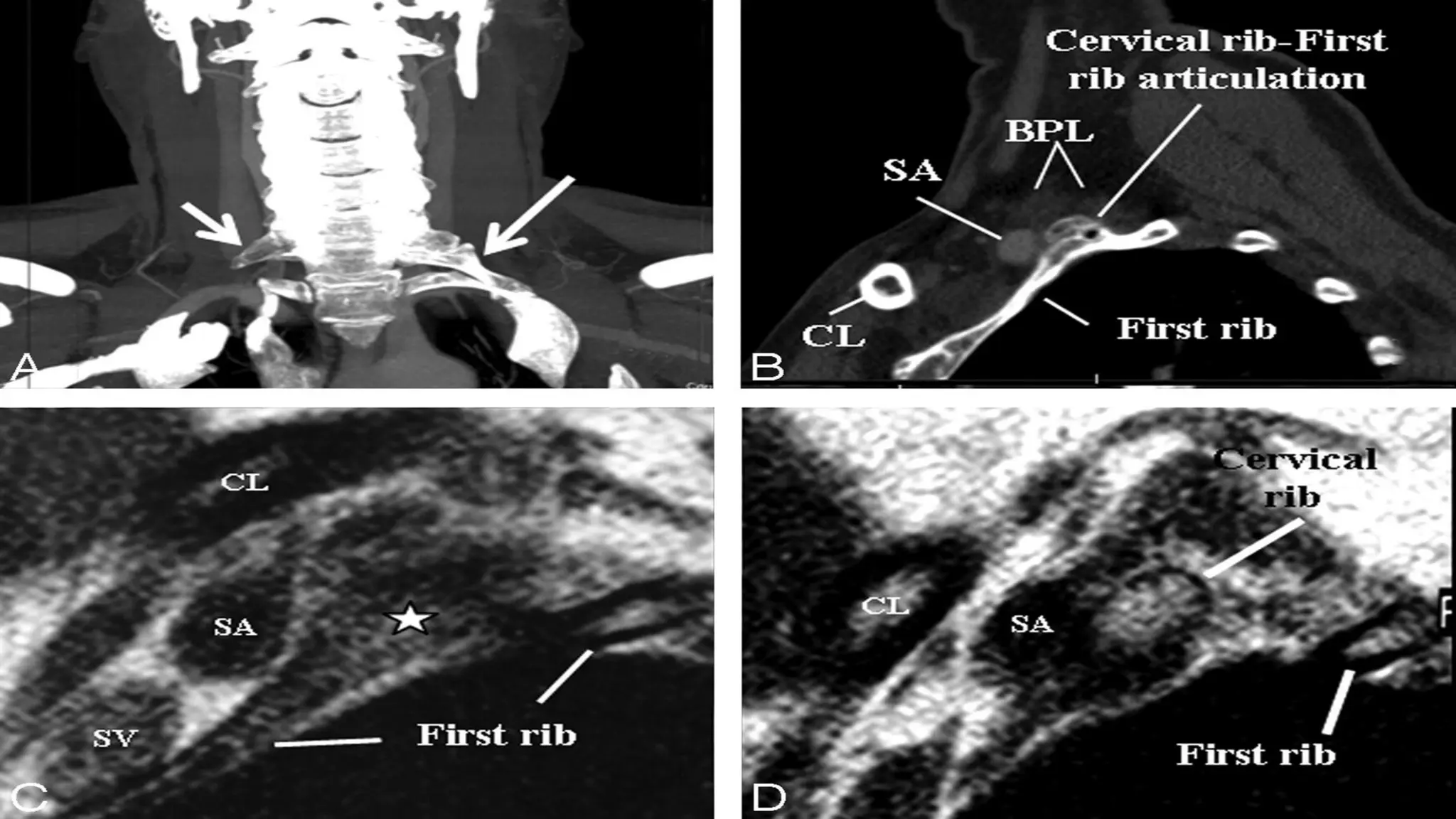 THORACIC OUTLET SYNDROME(TOS)-PPT..pptx