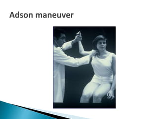 Adson Maneuver