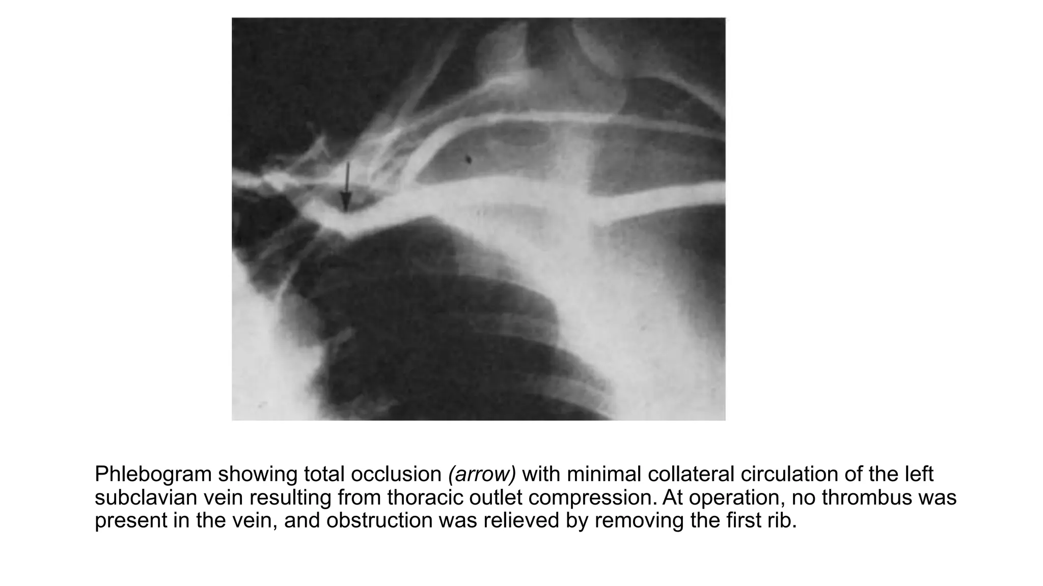 Thoracic Outlet Syndrome and Dorsal Sympathectomy.pptx
