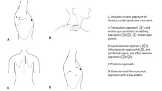 Thoracic Outlet Syndrome and Dorsal Sympathectomy.pptx