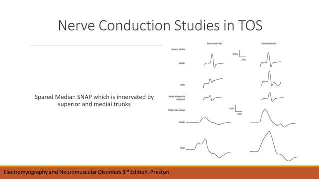 Thoracic Outlet Syndrome; Focus on Electrodiagnostic Studies | PPT