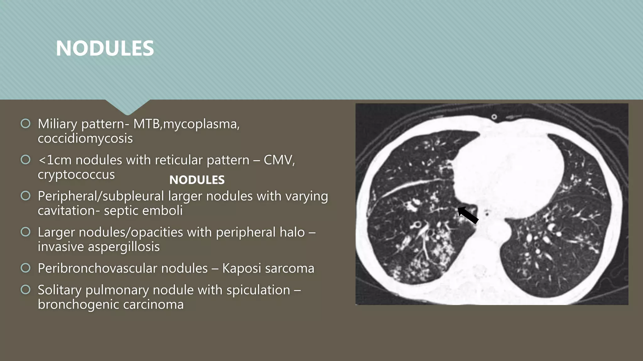 Thoracic pathologies in immunocompromised | PPTX