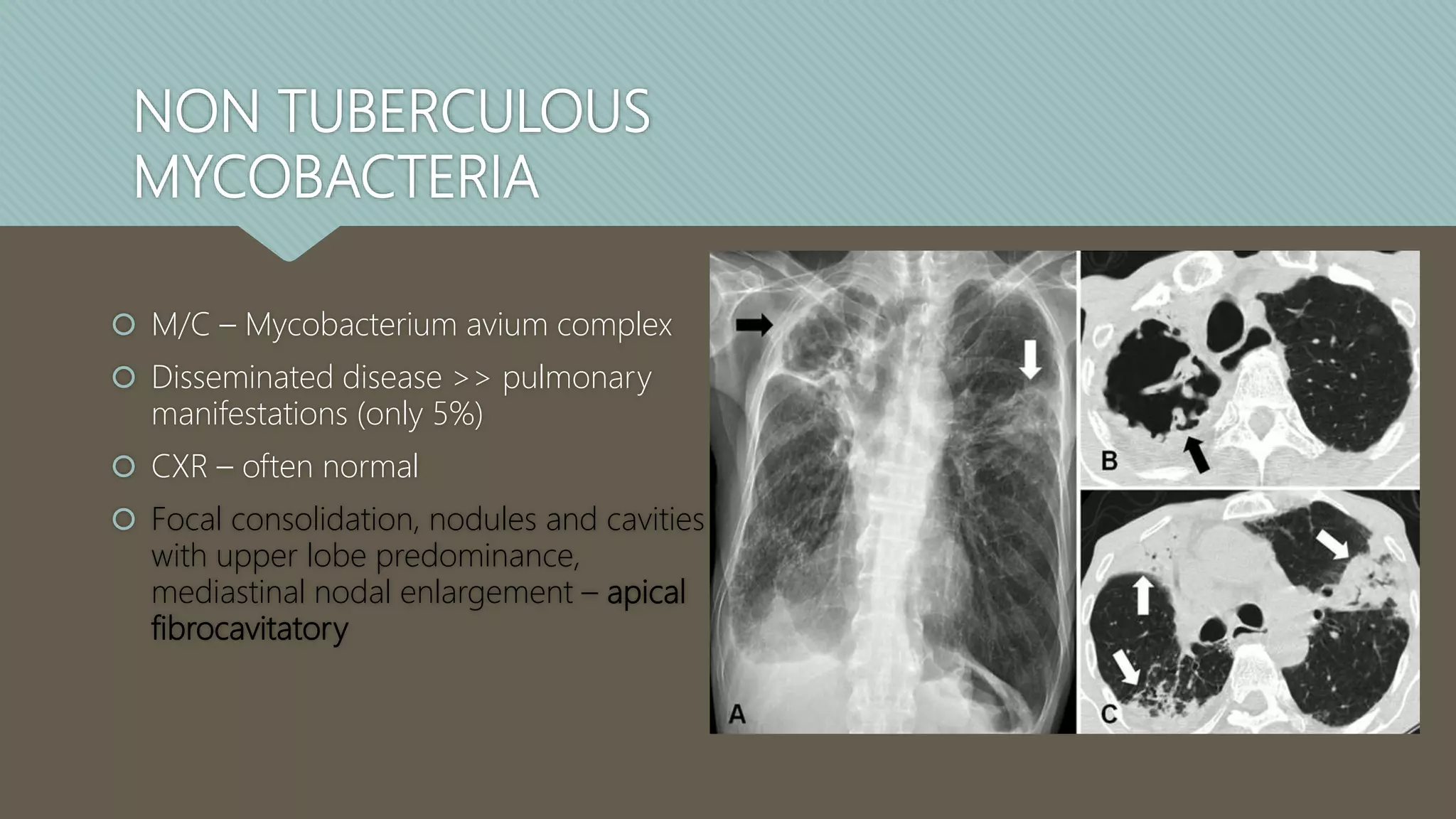 Thoracic pathologies in immunocompromised | PPTX