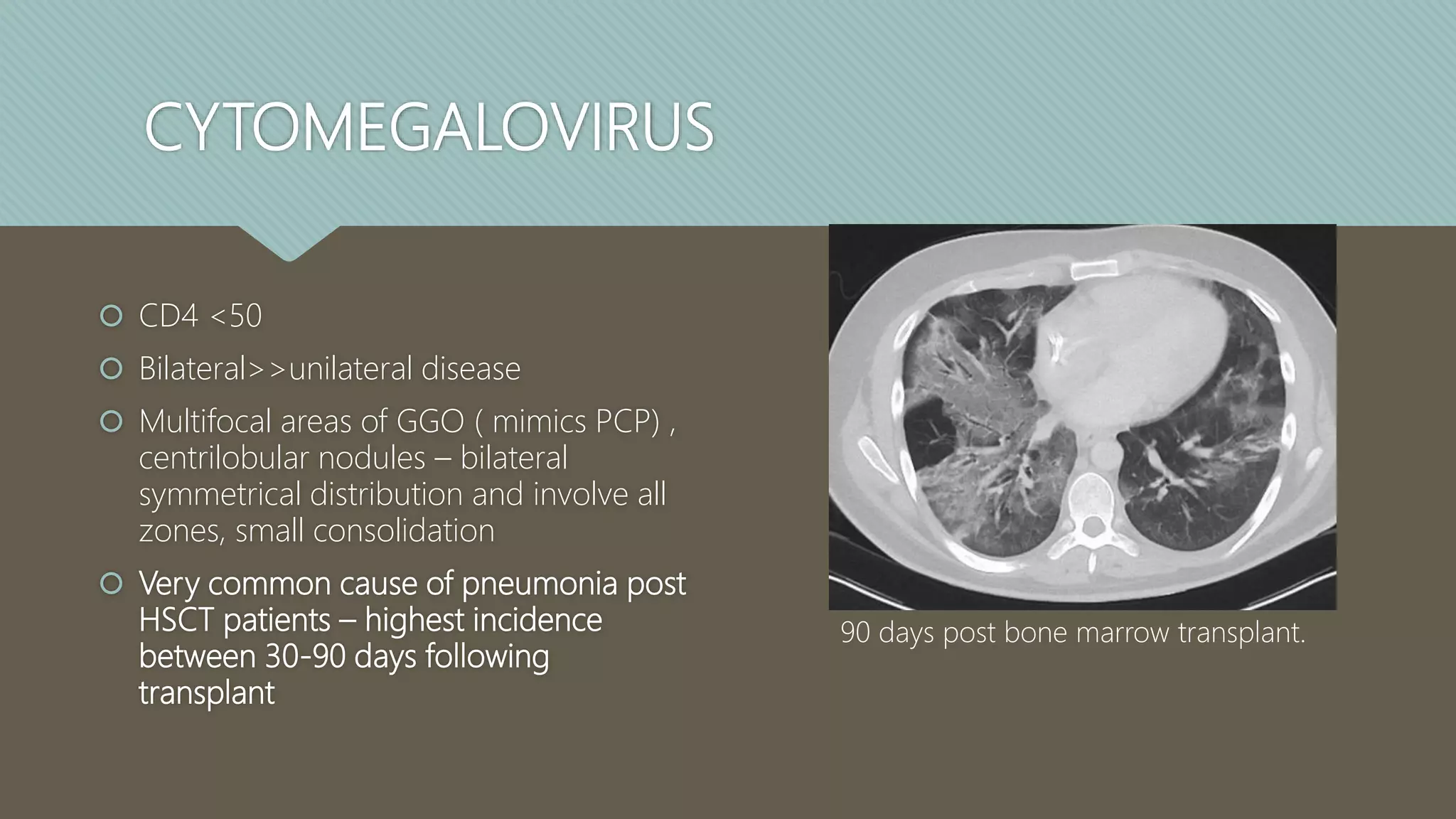 Thoracic pathologies in immunocompromised | PPTX