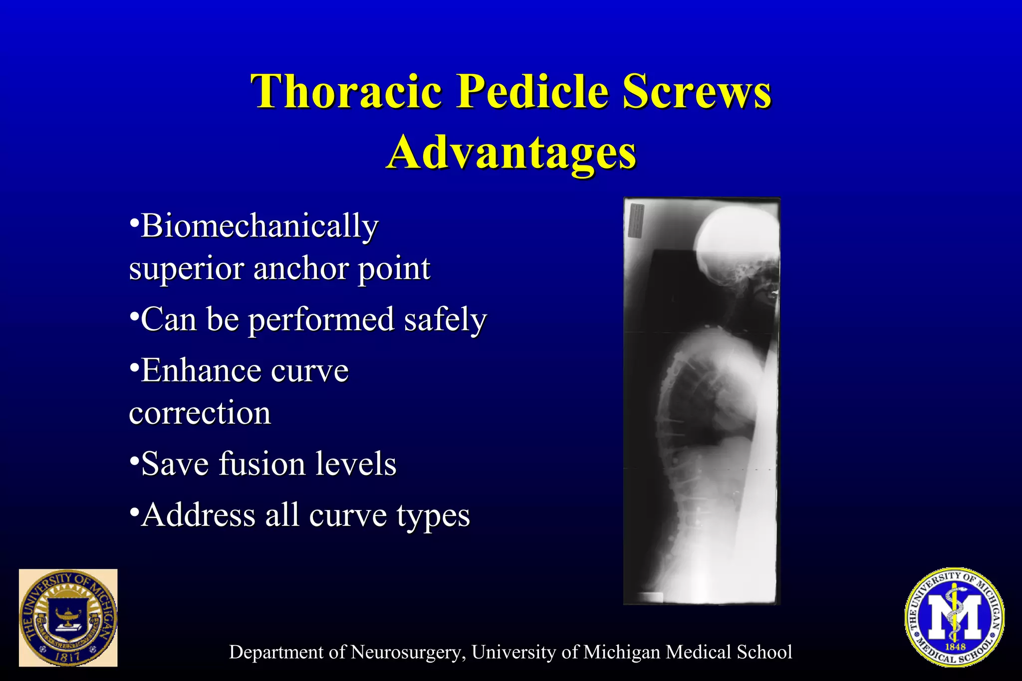 Thoracic pedicle screws | PPT