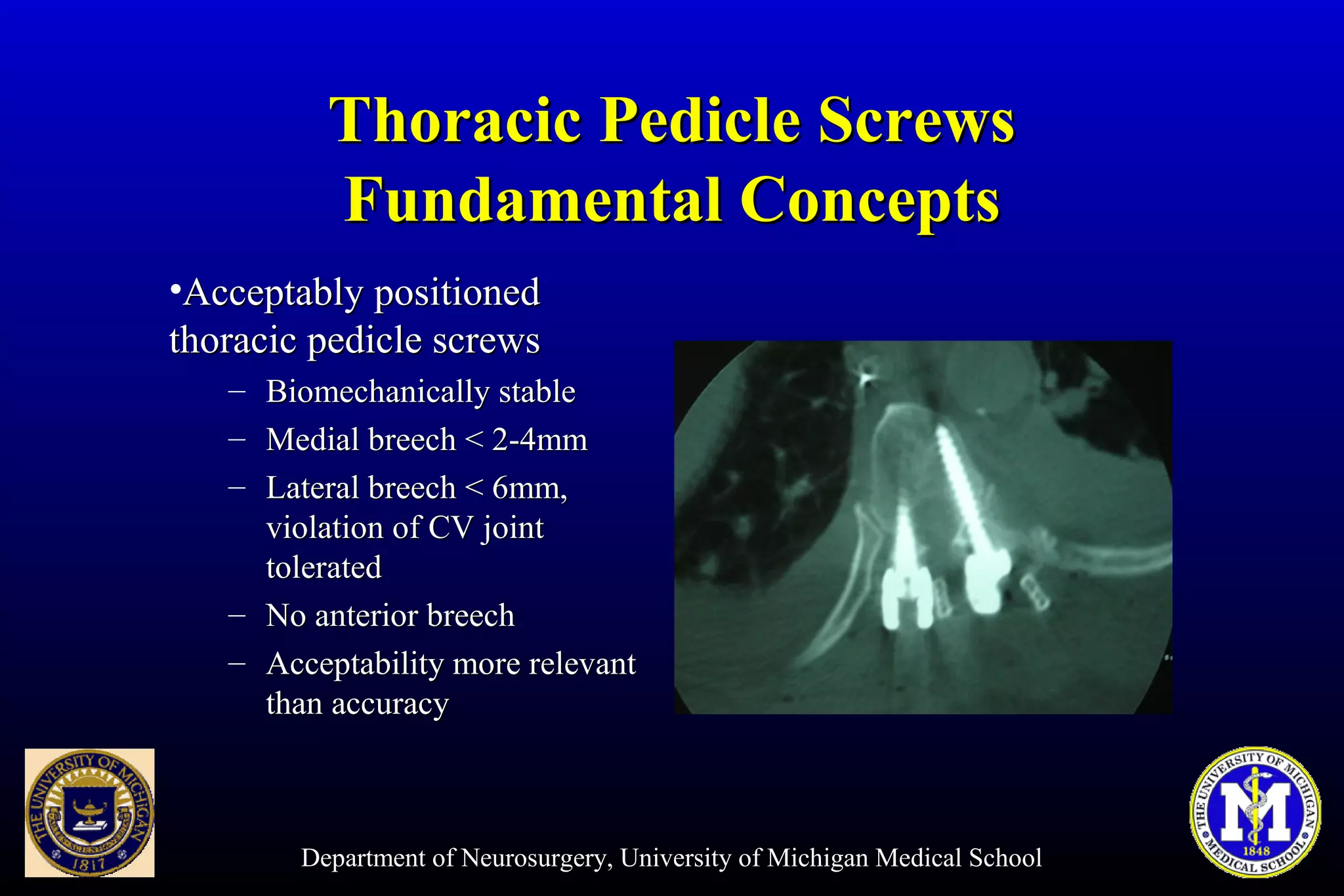 Thoracic pedicle screws | PPT