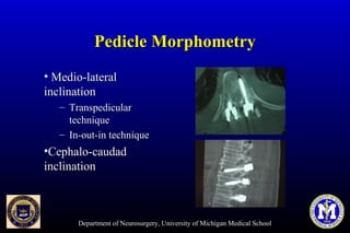 Thoracic pedicle screws | PPT