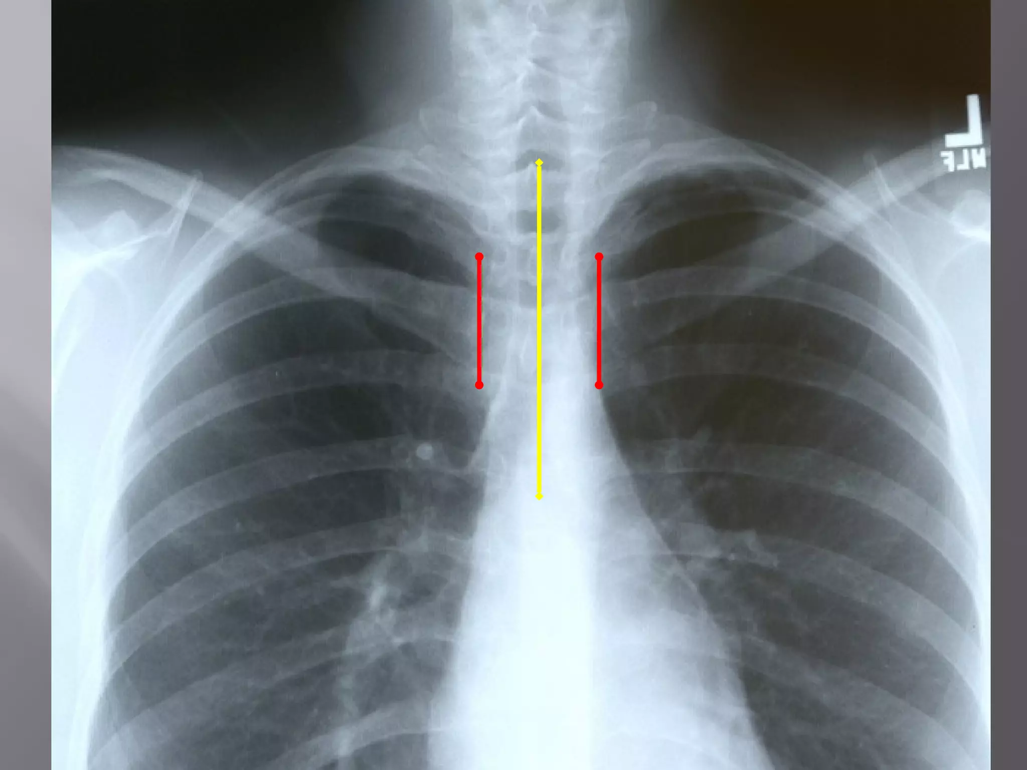 Thoracic positioning | PPT