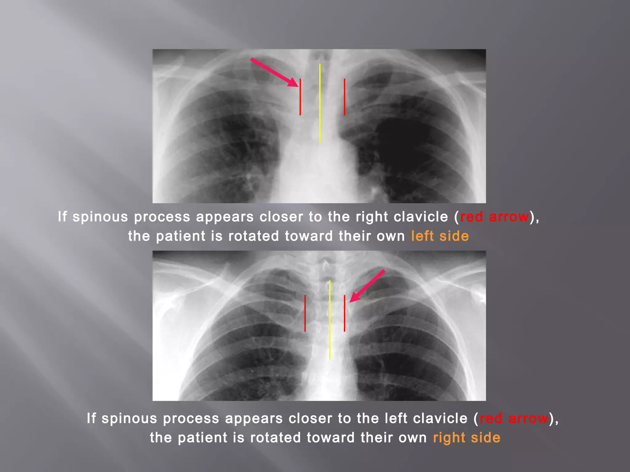 Thoracic positioning | PPT