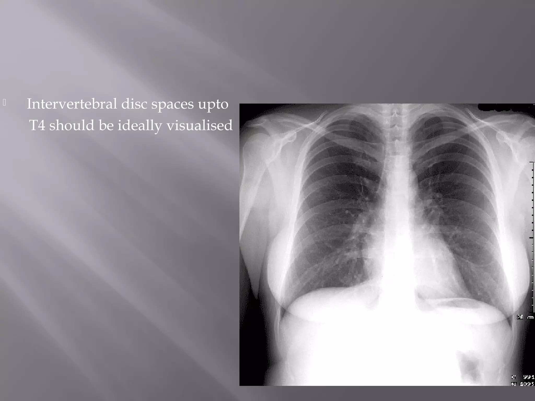 Thoracic positioning | PPT
