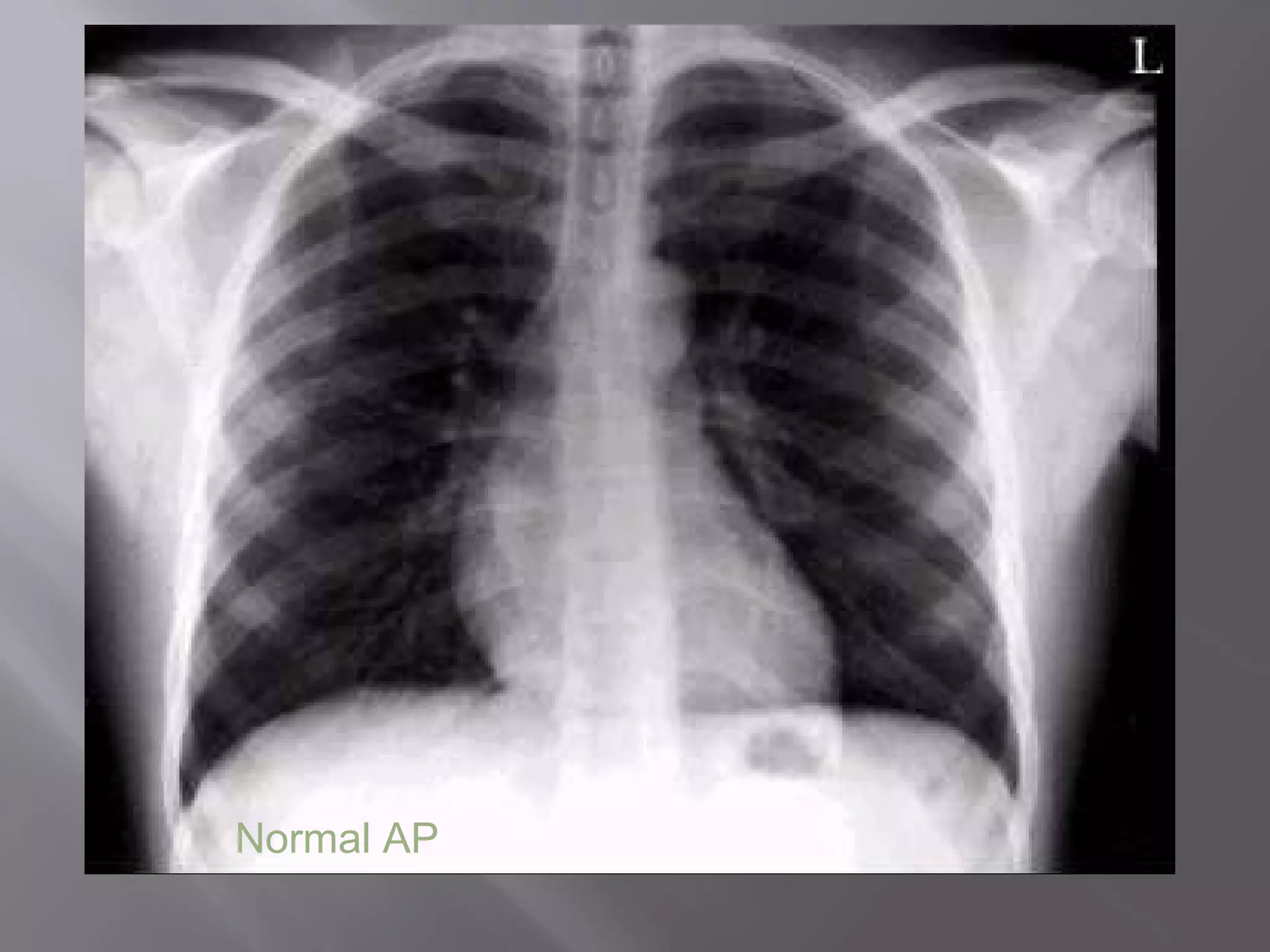 Thoracic positioning | PPT