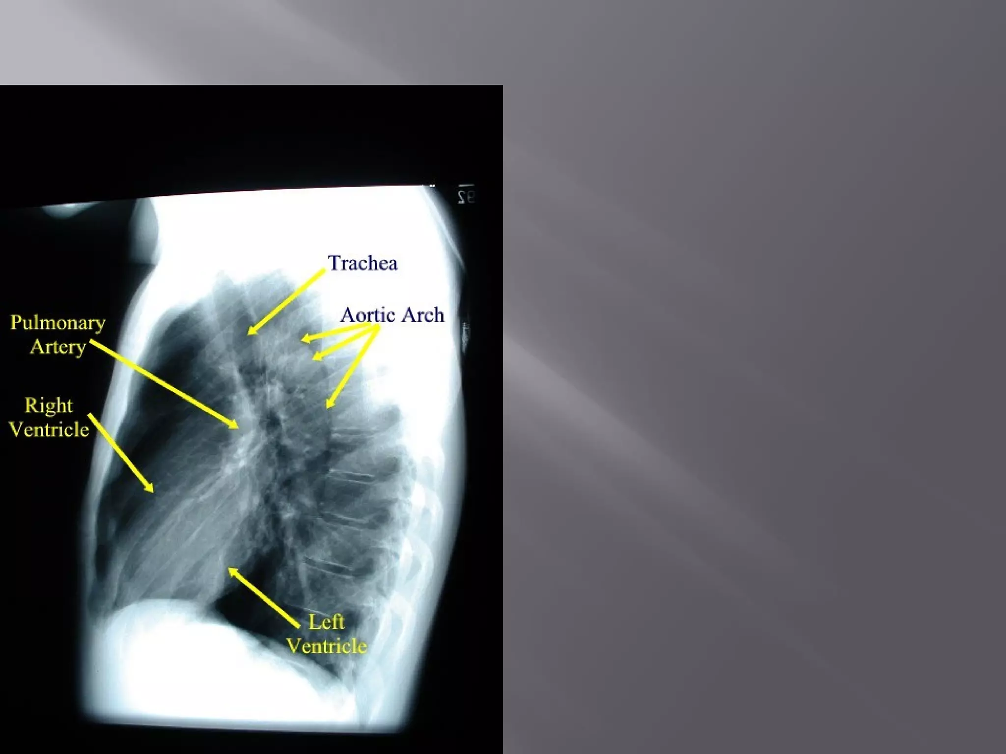 Thoracic positioning | PPT