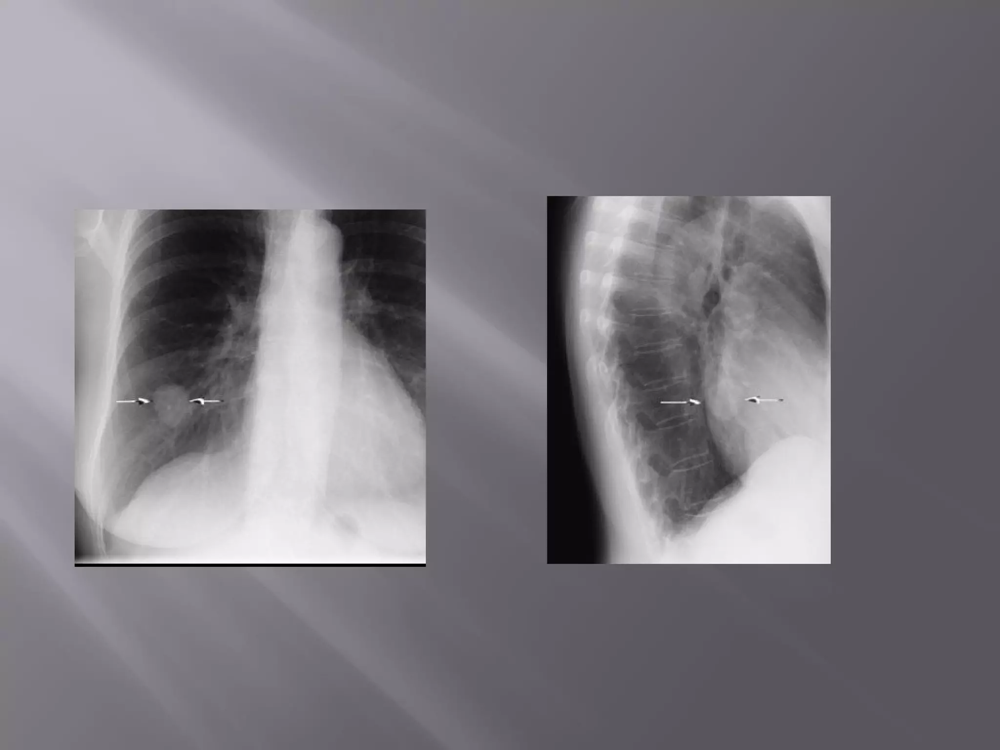 Thoracic positioning | PPT