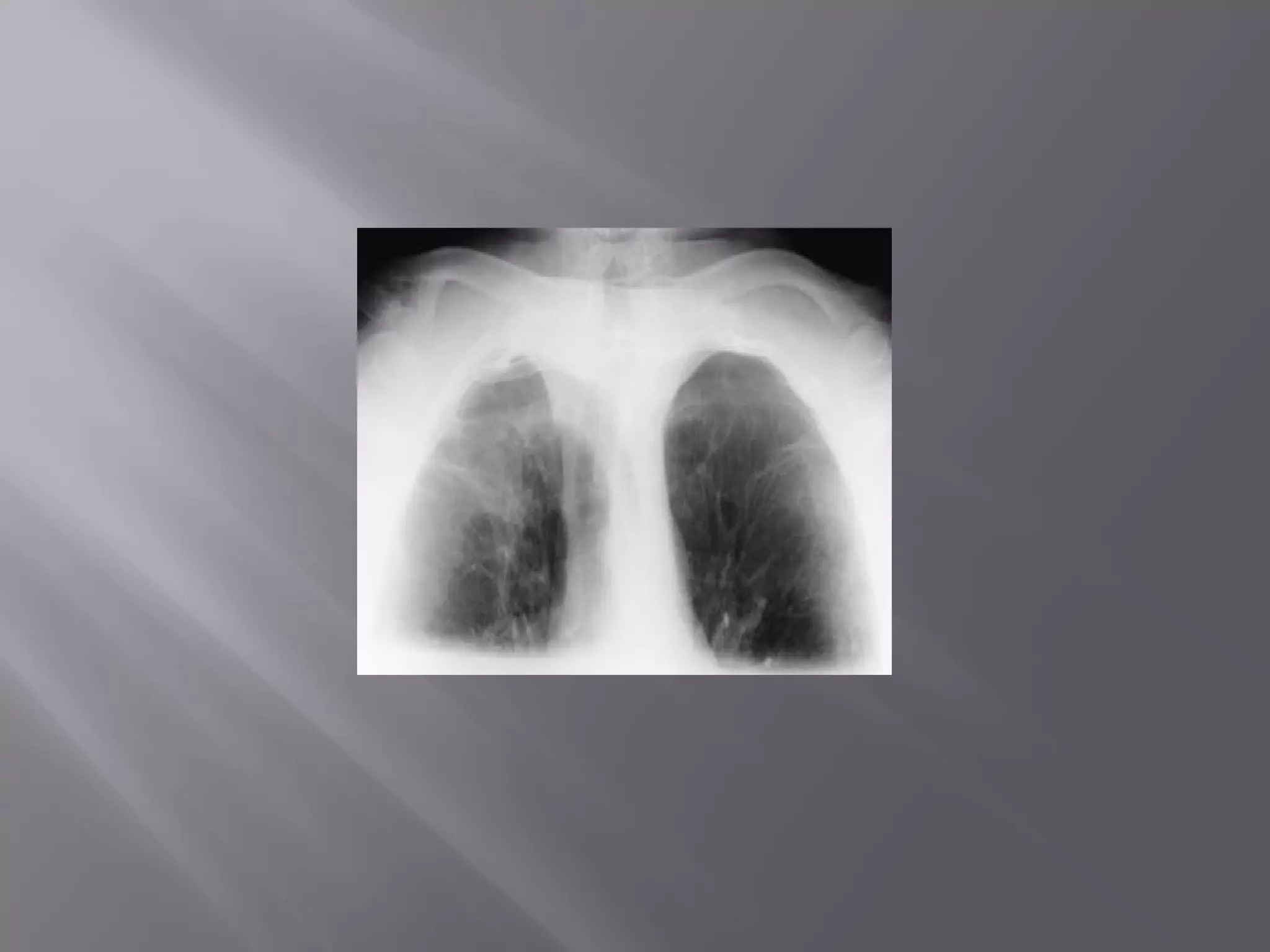 Thoracic positioning | PPT