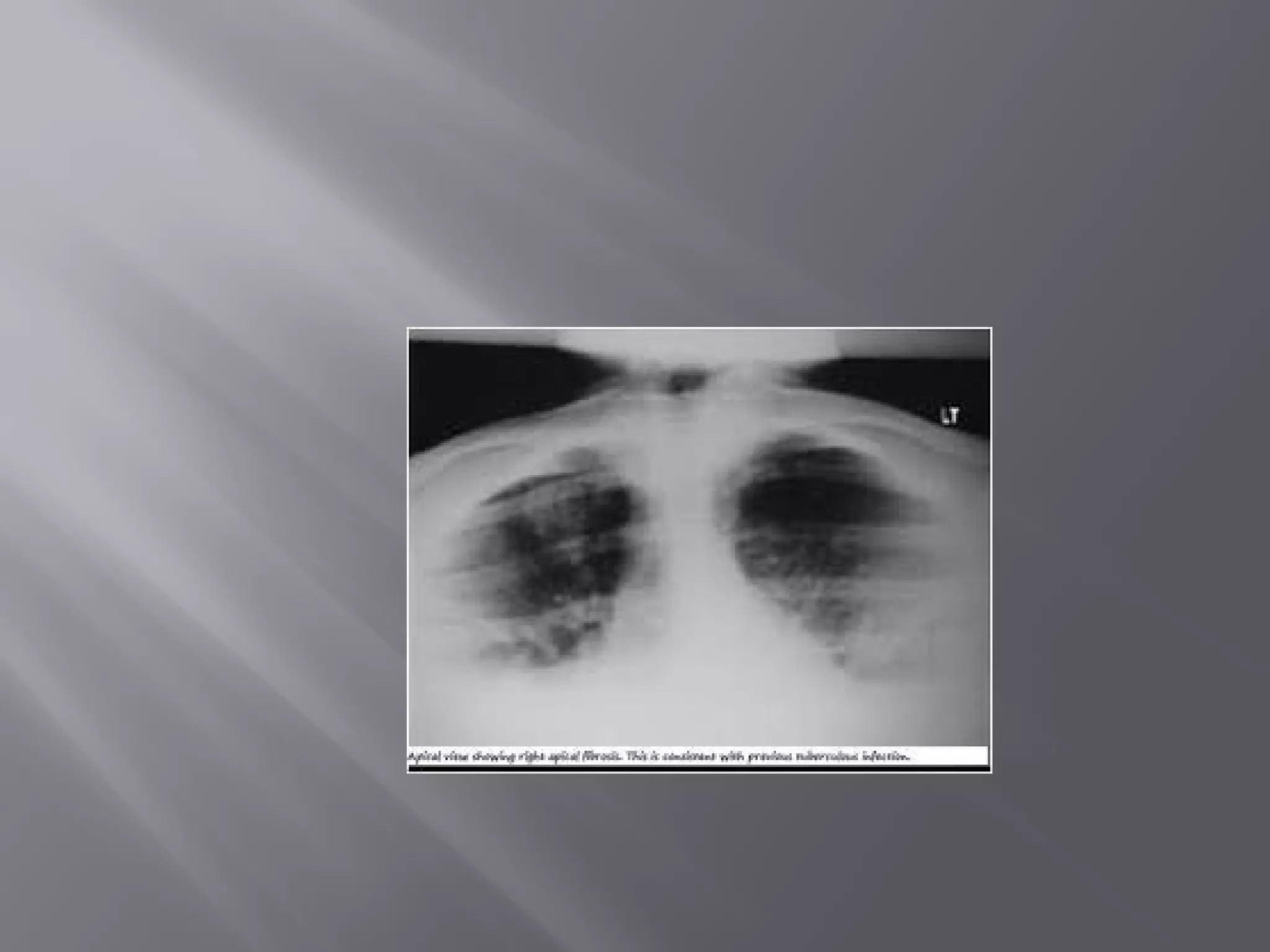 Thoracic positioning | PPT