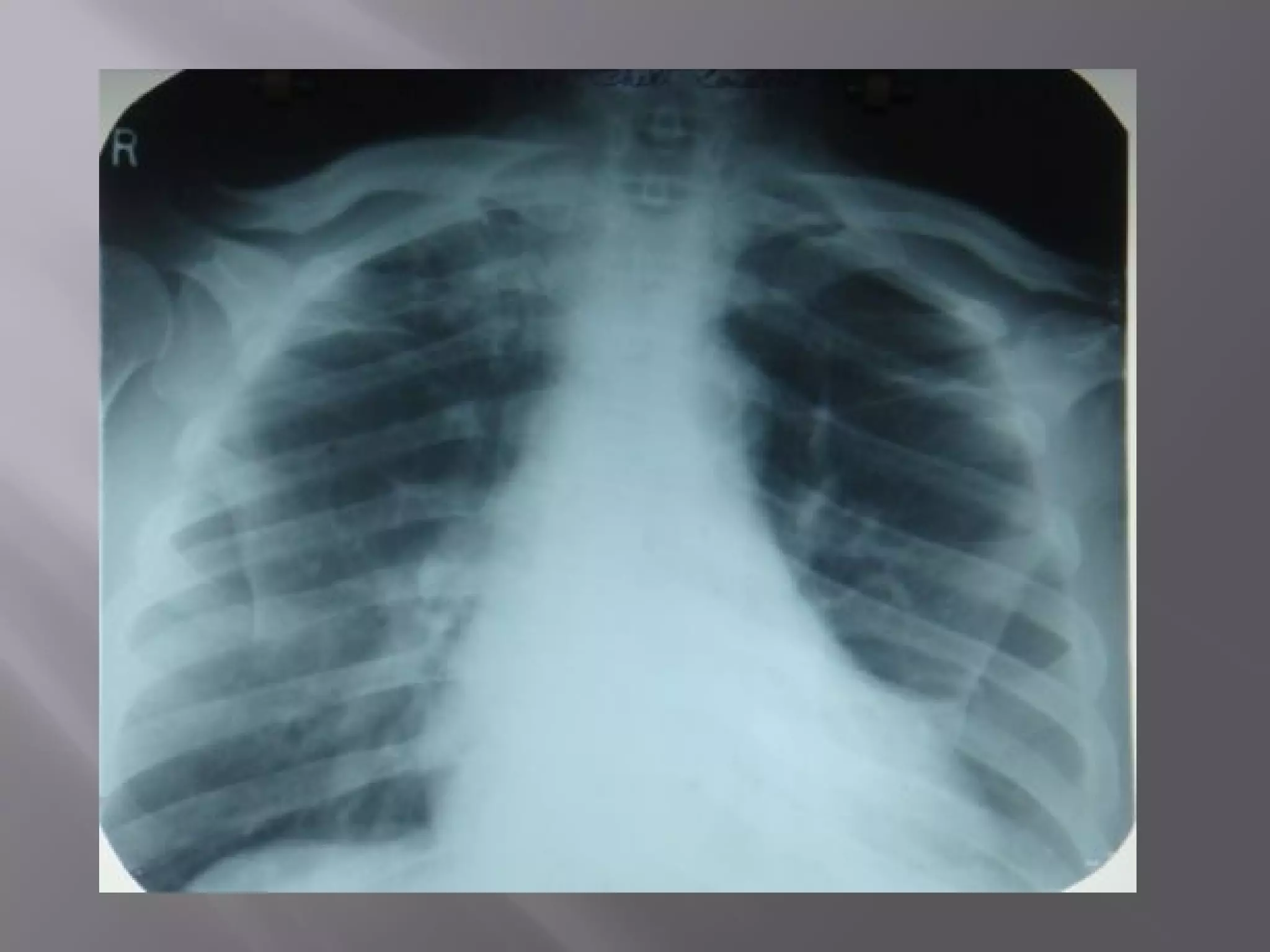 Thoracic positioning | PPT