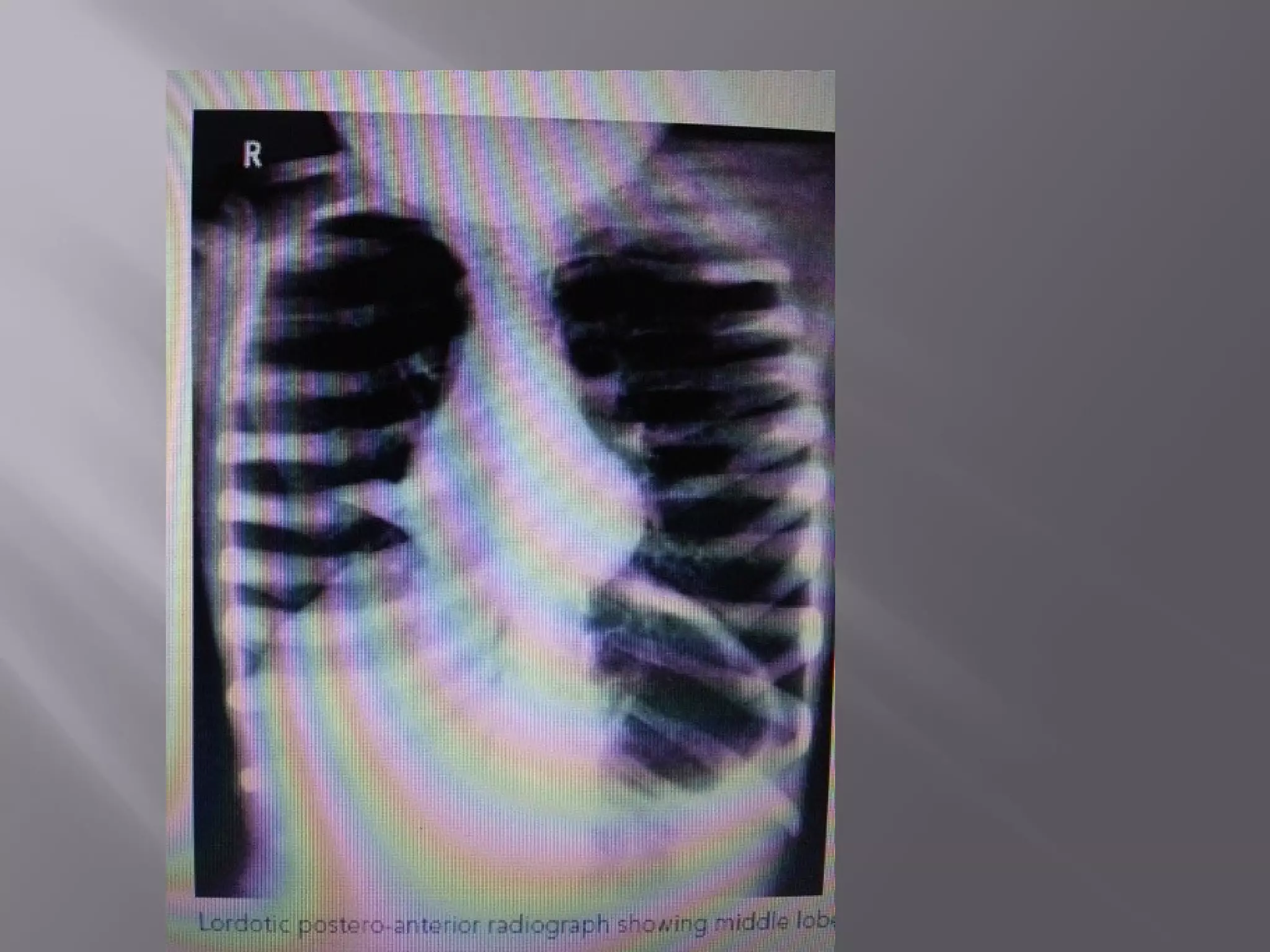 Thoracic positioning | PPT
