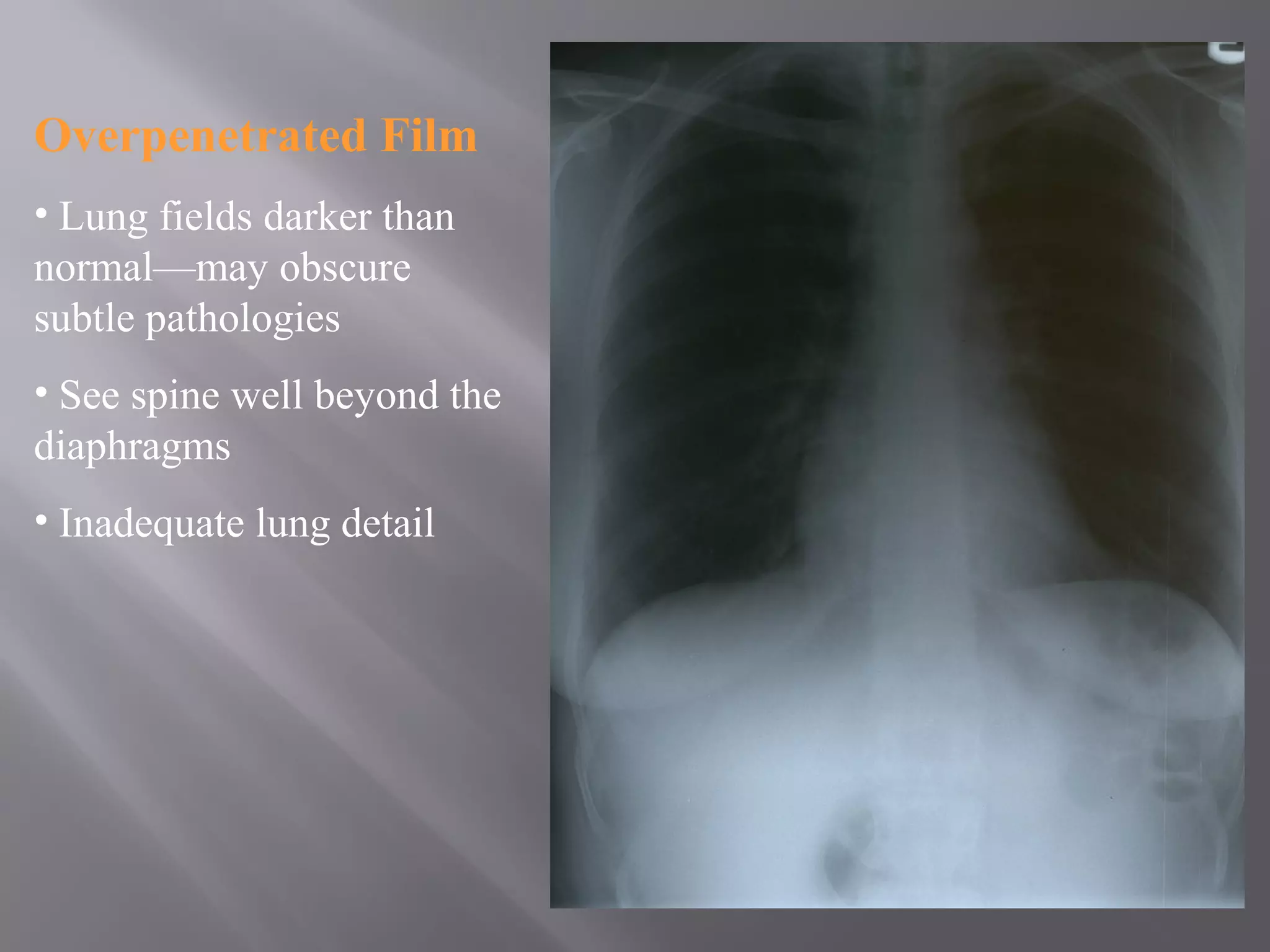 Thoracic positioning | PPT