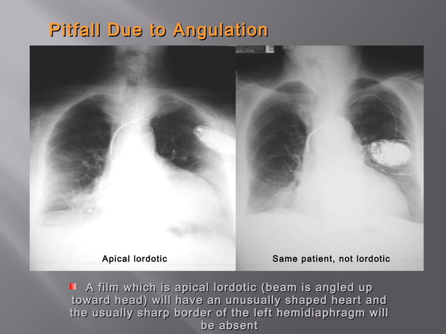 Thoracic positioning | PPT | Lung and Respiratory Health | Diseases and ...