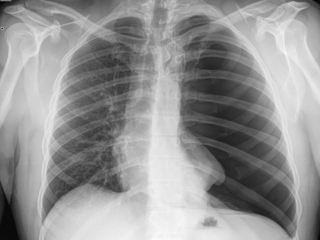 Thoracic positioning | PPT | Lung and Respiratory Health | Diseases and ...
