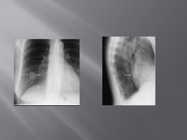 Thoracic positioning | PPT | Lung and Respiratory Health | Diseases and ...