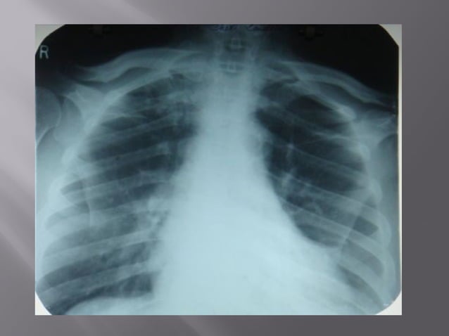 Thoracic positioning | PPT | Lung and Respiratory Health | Diseases and ...
