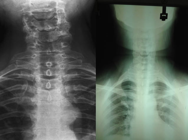 Thoracic positioning | PPT | Lung and Respiratory Health | Diseases and ...