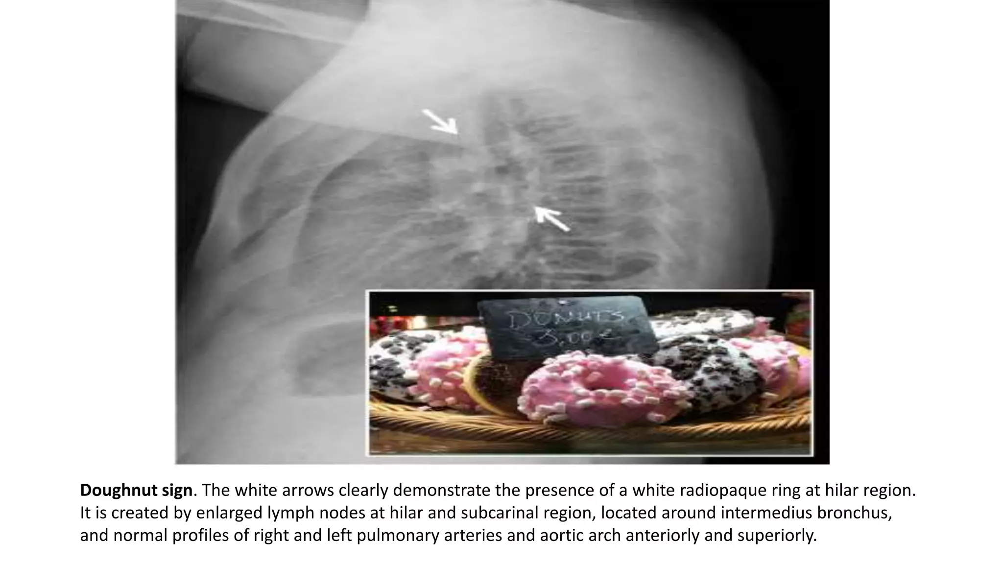 Thoracic radiological signs | PPT