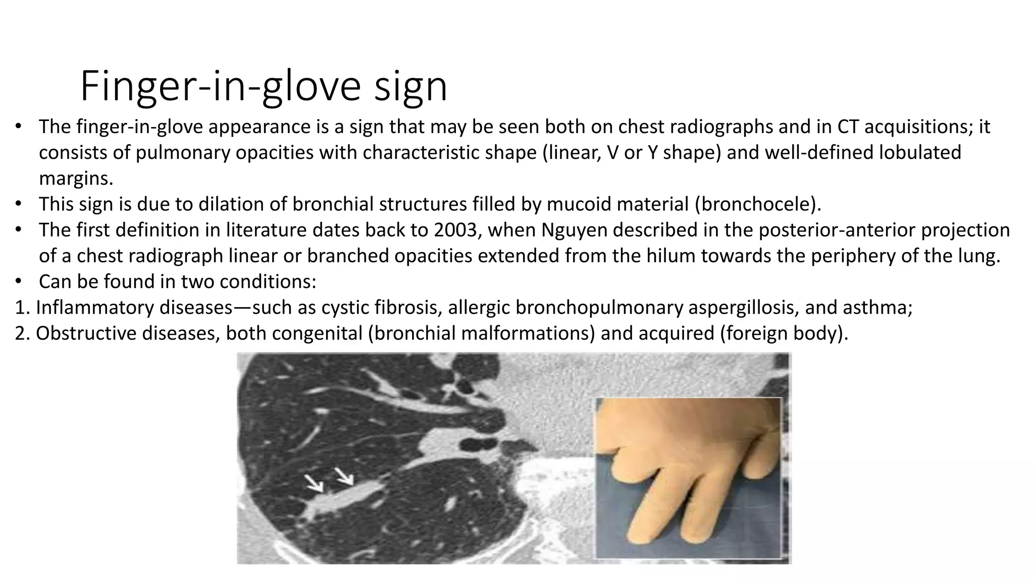 Thoracic radiological signs | PPT