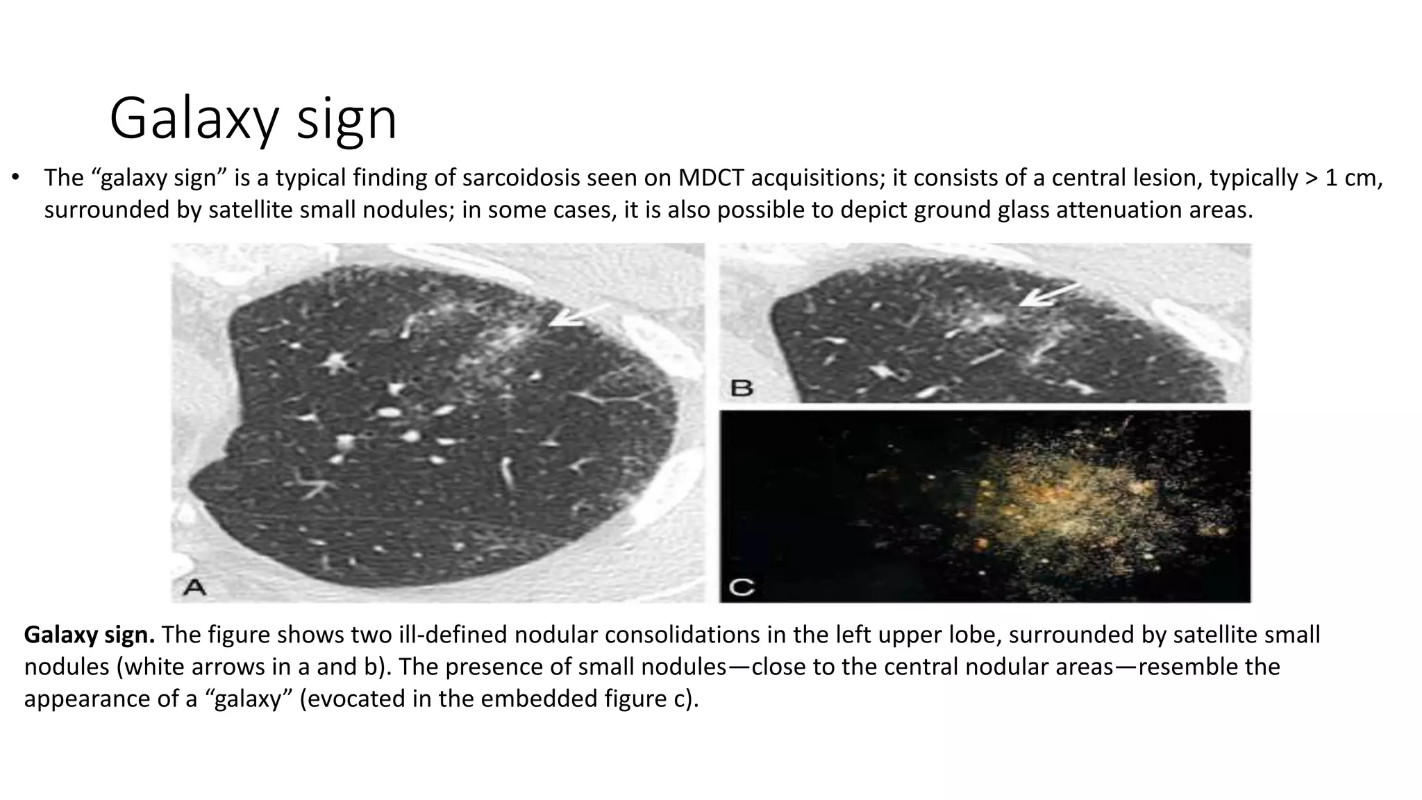 Thoracic radiological signs | PPT